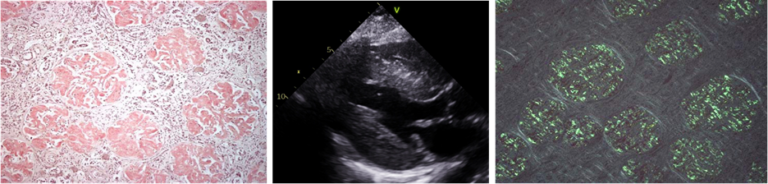 Amyloid Center of Excellence - Cardiovascular Division